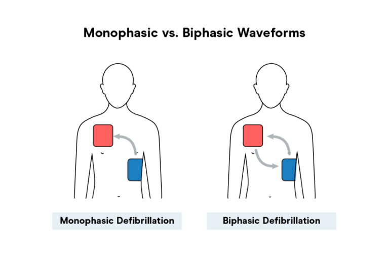 Biphasic vs Monophasic Defibrillation: Key Differences